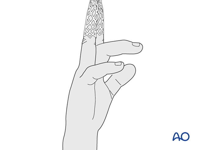 K-wire fixation for Dislocation and fracture-dislocation of the ...