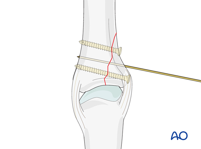 Lag-screw fixation for Partial articular fracture of the proximal end ...