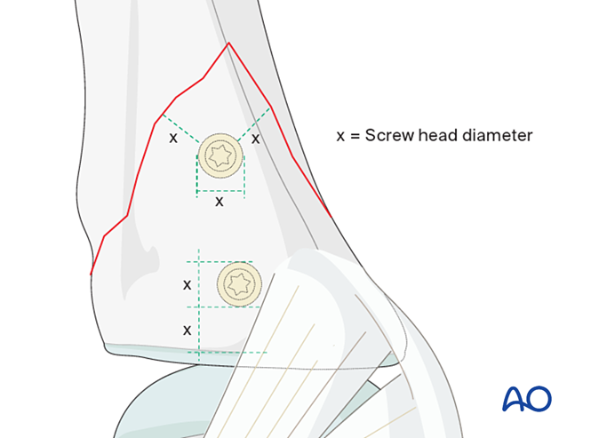 Lag-screw fixation for Partial articular fracture of the proximal end ...