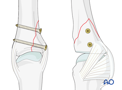 Lag-screw fixation for Partial articular fracture of the proximal end ...