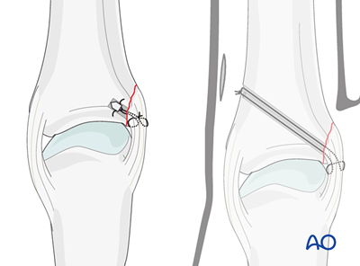 Collateral ligament reattachment for Avulsion at the proximal end segment