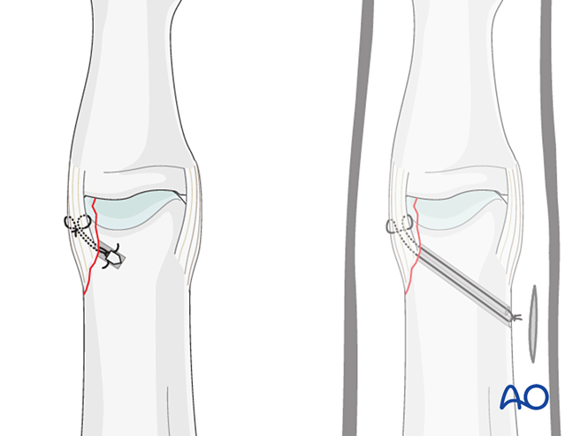 Collateral ligament reattachment for Partial articular fracture of the ...