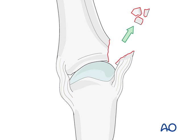 Collateral ligament reattachment for Avulsion at the proximal end segment