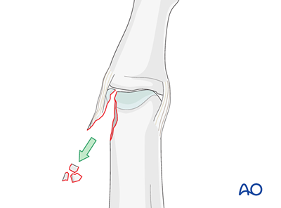 Collateral ligament reattachment for Partial articular fracture of the ...