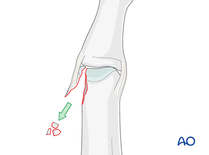 Collateral ligament reattachment for Partial articular fracture of the ...
