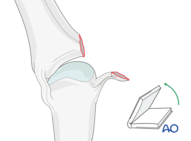 Collateral ligament reattachment for Avulsion at the proximal end segment