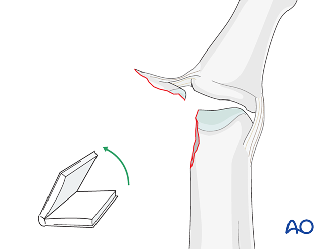 Collateral ligament reattachment for Partial articular fracture of the ...