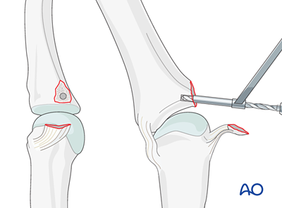 Collateral ligament reattachment for Avulsion at the proximal end segment