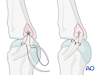 Collateral ligament reattachment for Avulsion at the proximal end segment