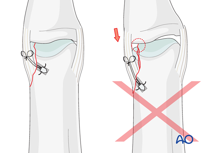 Collateral ligament reattachment for Partial articular fracture of the ...