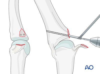 Collateral ligament reattachment for Avulsion at the proximal end segment