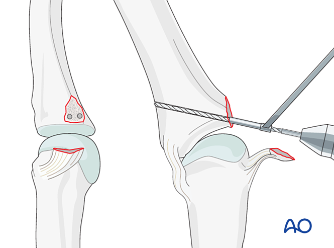 Collateral ligament reattachment for Avulsion at the proximal end segment