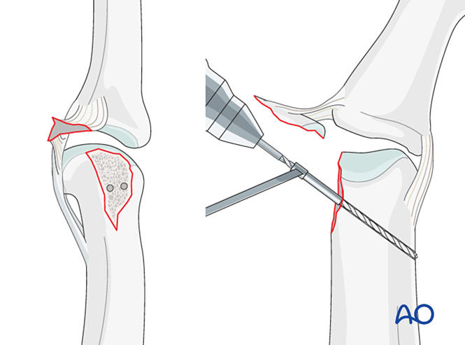 Collateral ligament reattachment for Partial articular fracture of the ...
