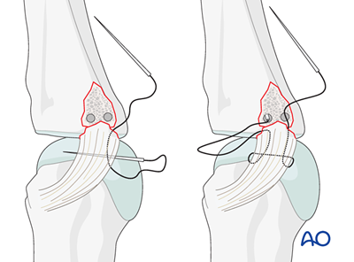 Collateral ligament reattachment for Avulsion at the proximal end segment