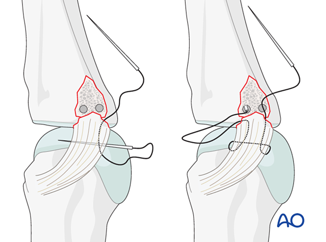 Collateral ligament reattachment for Avulsion at the proximal end segment