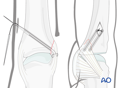 Collateral ligament reattachment for Avulsion at the proximal end segment