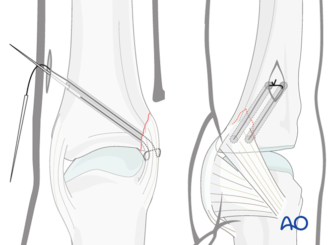 Collateral ligament reattachment for Avulsion at the proximal end segment