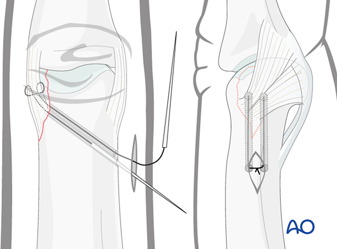 Collateral ligament reattachment for Partial articular fracture of the ...