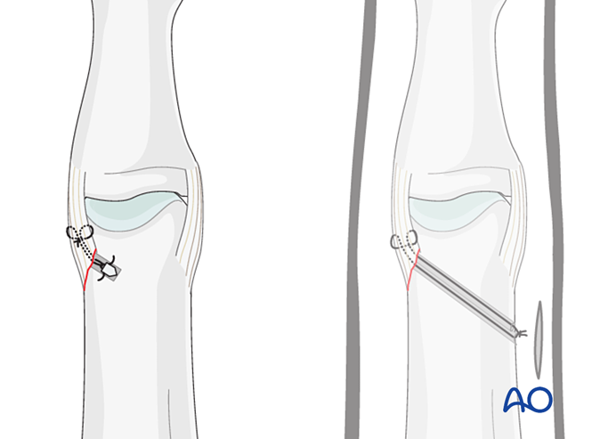 Collateral ligament repair for Dislocation and fracture-dislocation of ...