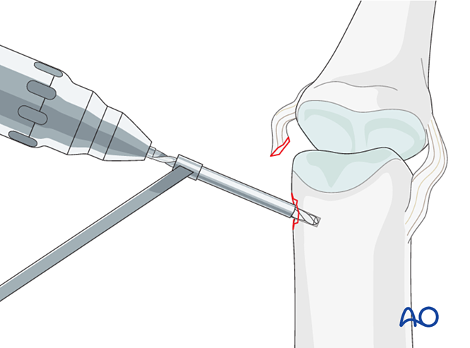 Collateral ligament repair for Dislocation and fracture-dislocation of ...