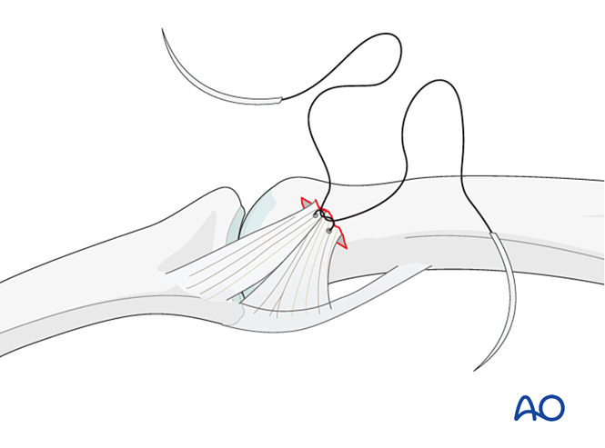Collateral ligament repair for Dislocation and fracture-dislocation of ...