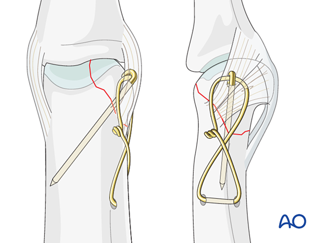 Cerclage compression wiring for Partial articular fracture of the ...