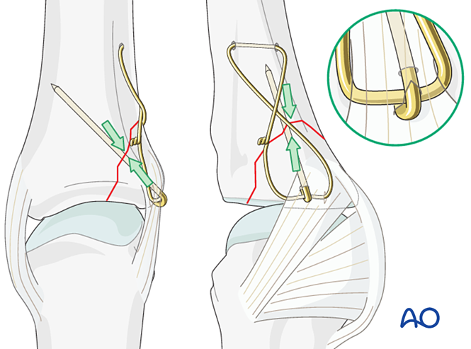 Cerclage compression wiring for Avulsion at the proximal end segment