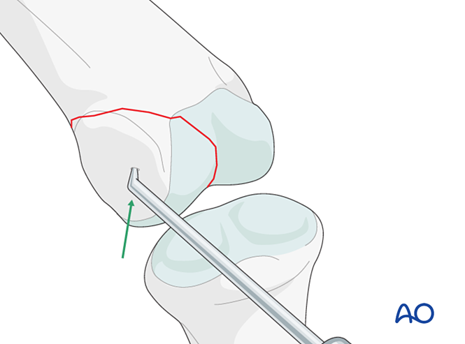 Cerclage compression wiring for Partial articular fracture of the ...