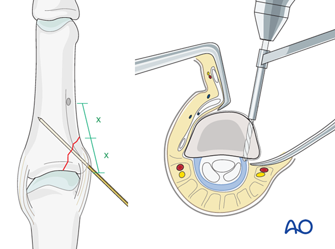 Cerclage compression wiring for Avulsion at the proximal end segment
