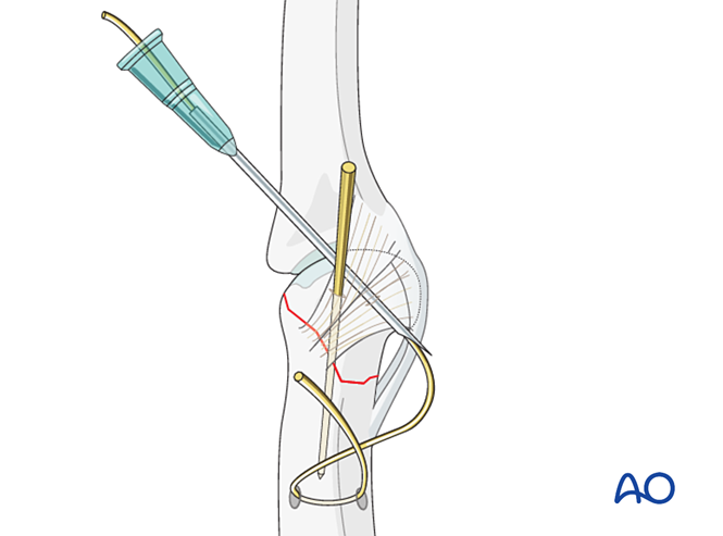 Cerclage compression wiring for Partial articular fracture of the ...