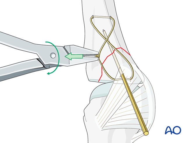 Cerclage compression wiring for Avulsion at the proximal end segment