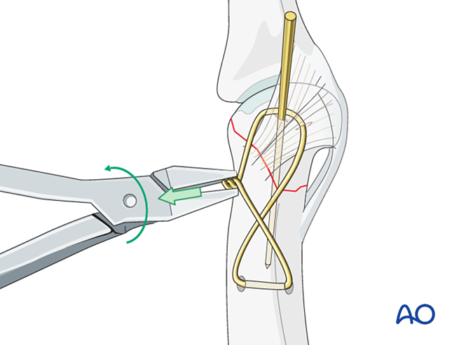 Cerclage compression wiring for Partial articular fracture of the ...