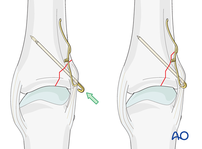 Cerclage compression wiring for Avulsion at the proximal end segment
