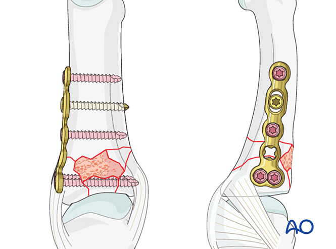 Plating with a lateral plate for Complete articular fracture of the ...