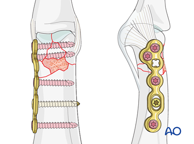 Plating with a lateral plate for Complete articular fracture of the ...