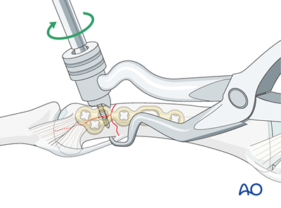 Plating with a lateral plate for Complete articular fracture of the ...