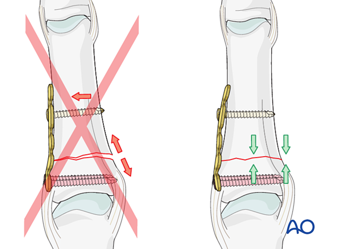 Plating with a lateral plate for Complete articular fracture of the ...