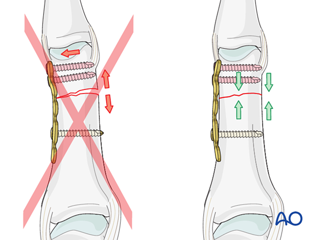 Plating with a lateral plate for Complete articular fracture of the ...