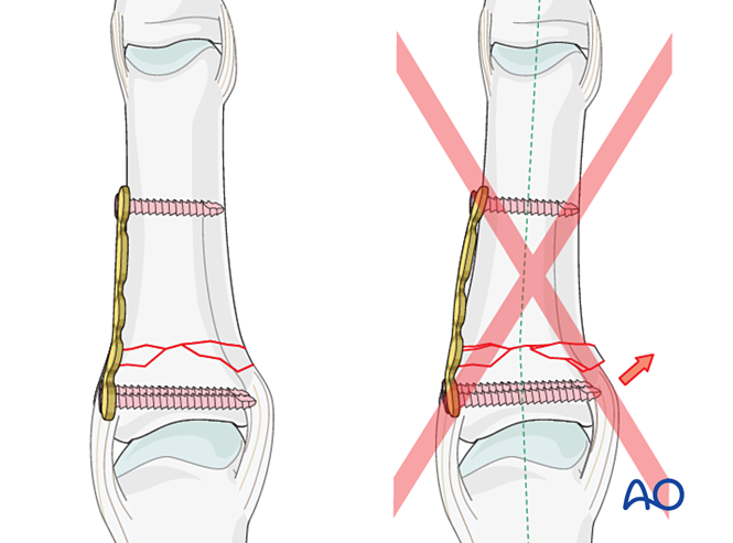 Plating with a lateral plate for Complete articular fracture of the ...