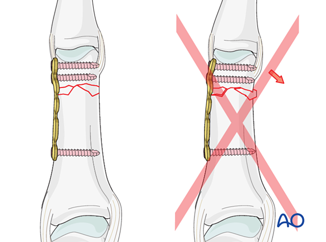 Plating with a lateral plate for Complete articular fracture of the ...