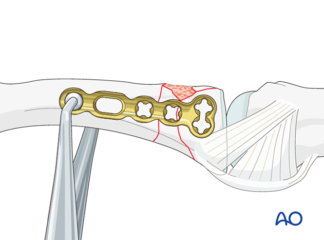 Plating with a lateral plate for Complete articular fracture of the ...