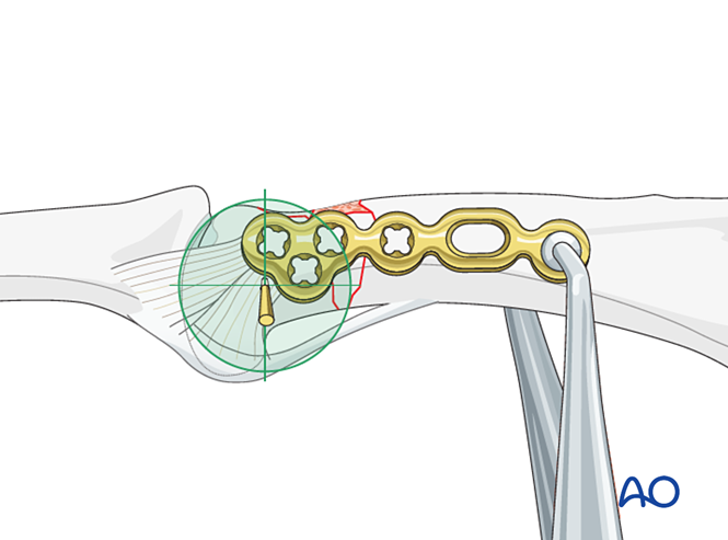 Plating with a lateral plate for Complete articular fracture of the ...