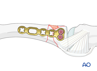 Plating with a lateral plate for Complete articular fracture of the ...