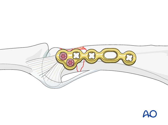 Plating with a lateral plate for Complete articular fracture of the ...