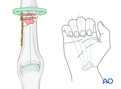 Plating with a lateral plate for Complete articular fracture of the ...