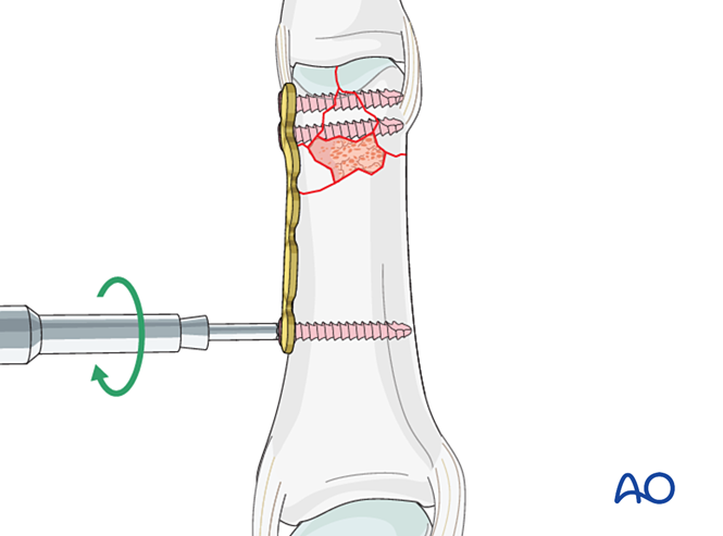 Plating with a lateral plate for Complete articular fracture of the ...