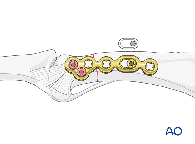 Plating with a lateral plate for Complete articular fracture of the ...