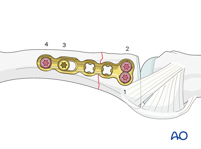 Plating with a lateral plate for Complete articular fracture of the ...