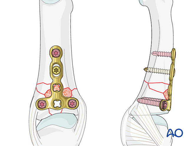 Plating with a dorsal T-plate for Complete articular fracture of the ...