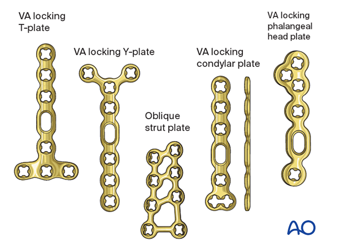 Plating with a lateral plate for Complete articular fracture of the ...